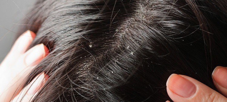 All You Need To Know About Common Dandruff - Gaylaxy Magazine